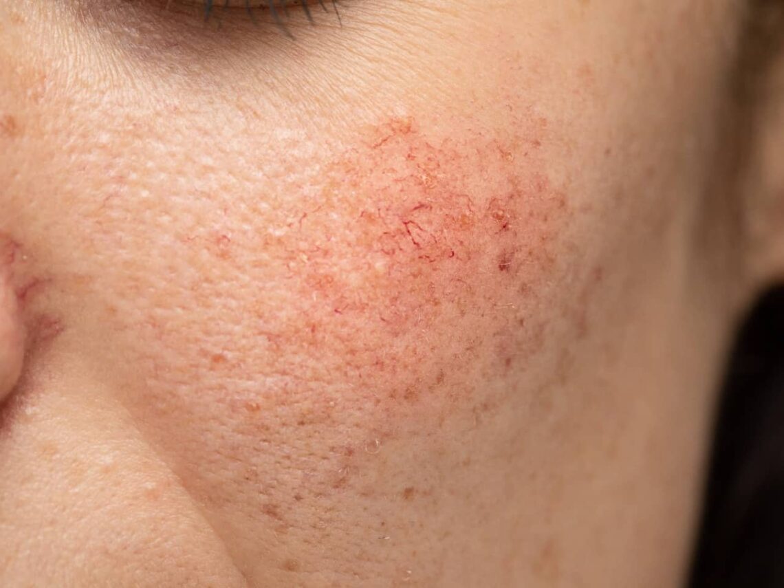 Comment faire disparaître la couperose sur le visage ? | Dr Ben Youssef ...