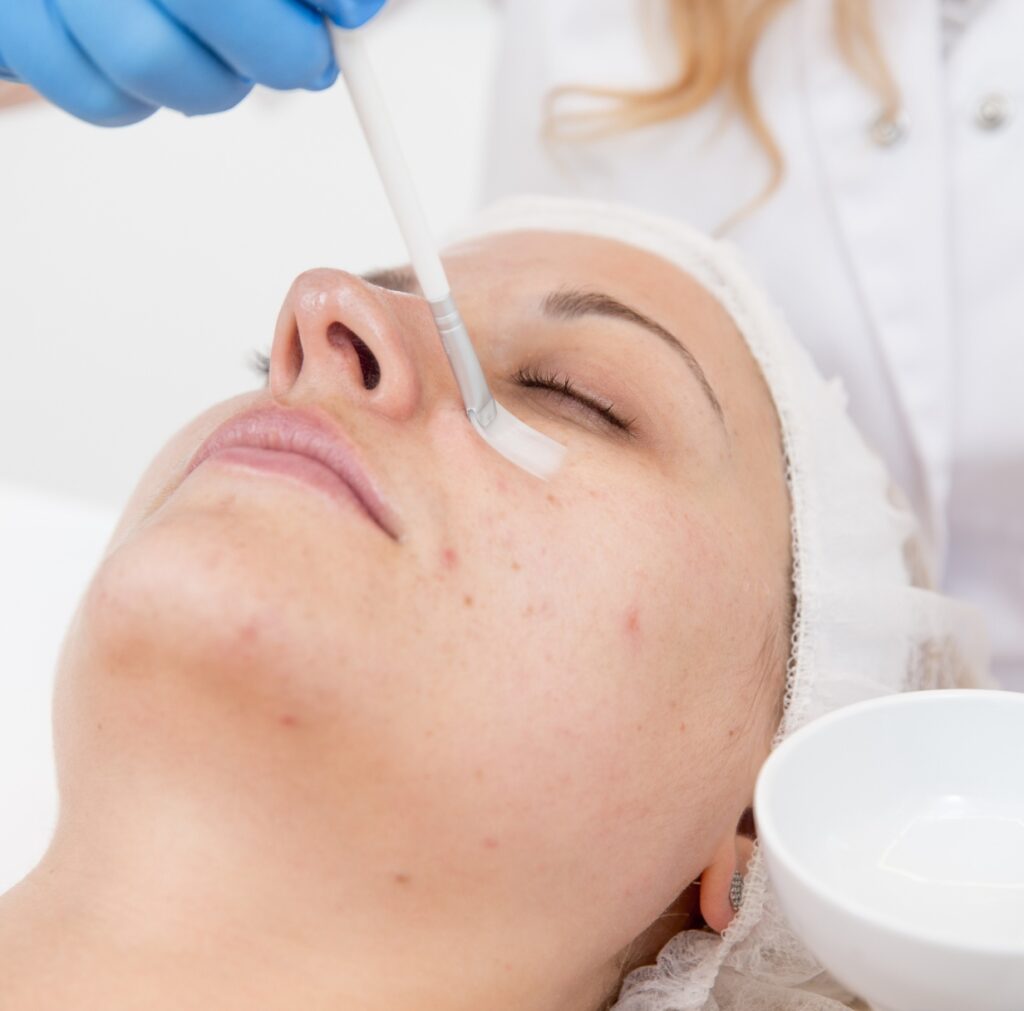 Traitement de l'acné avec le peeling | Technique | Paris | Dr Ben Youssef